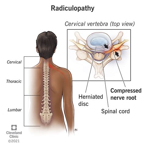 Radiculopathy Symptoms Causes And Treatment
