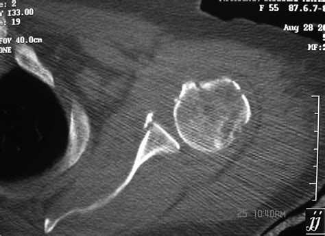 Msk Anterior Bankart Lesion And Proximal Humerus Fracture 1 Radioogle