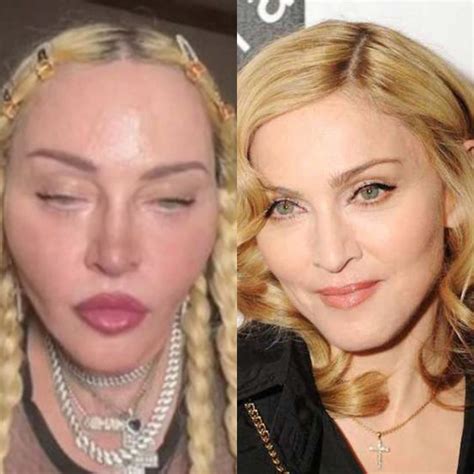 Madonna Undergoing Procedure To Look More Like Herself Following
