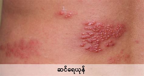 Shingles Herpes Zoster ဆင်ရေယုန် Cll Health