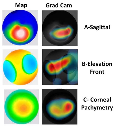 A Deep Feature Fusion Of Improved Suspected Keratoconus Detection With Deep Learning