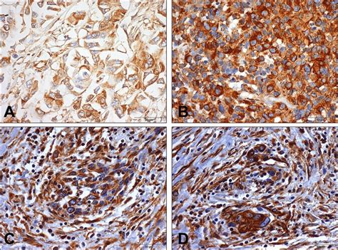 disease free survival in non muscle invasive bladder cancer nmibc