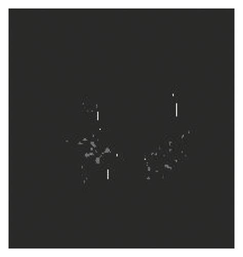 Effect Drawings Of Lung Parenchyma Image Segmentation At Each Stage Download Scientific