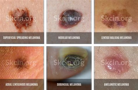 Melanoma Stages
