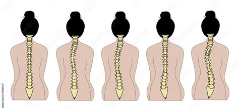 Types Of Scoliosis Spine Curvature Deformity Human Spinal Backbone Anatomy Orthopaedic