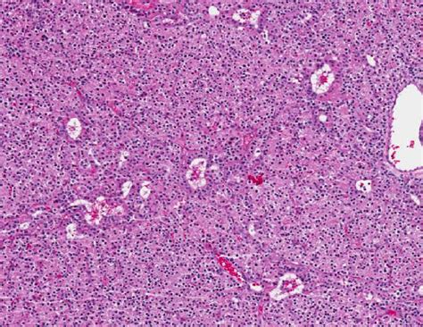 Hypercellular Parathyroid Gland Consistent With Adenoma Nests Of Download Scientific Diagram