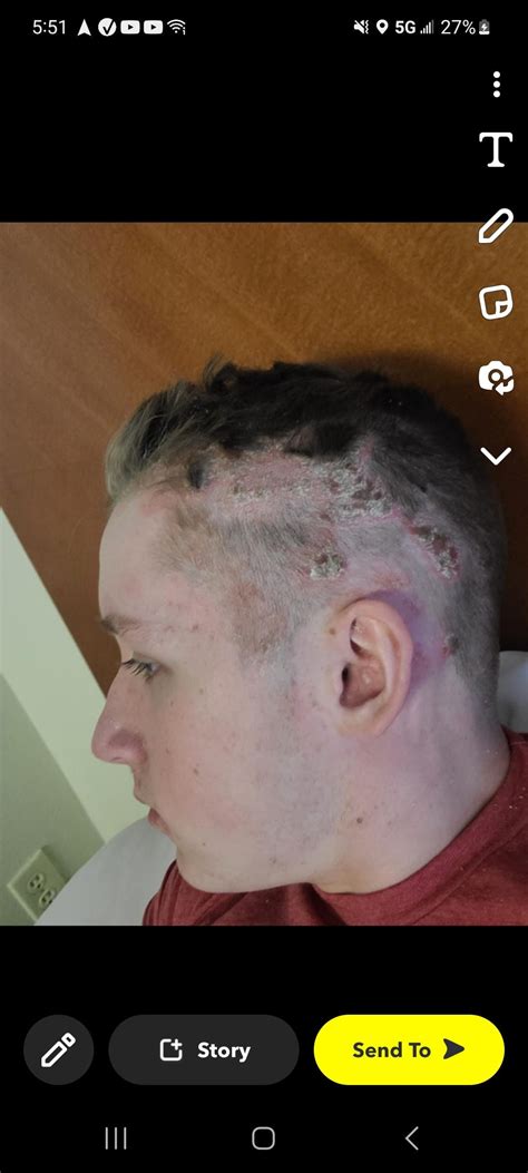 Scalp Psoriasis 1 Week Difference With Clobetasol Topical Solution R Psoriasis