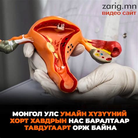 Умайн хүзүүний хавдрыг Алтан Эх эмэгтэйчүүдийн эмнэлэг Facebook