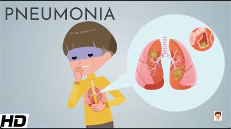 Pneumonia Everything You Need To Know Youtube