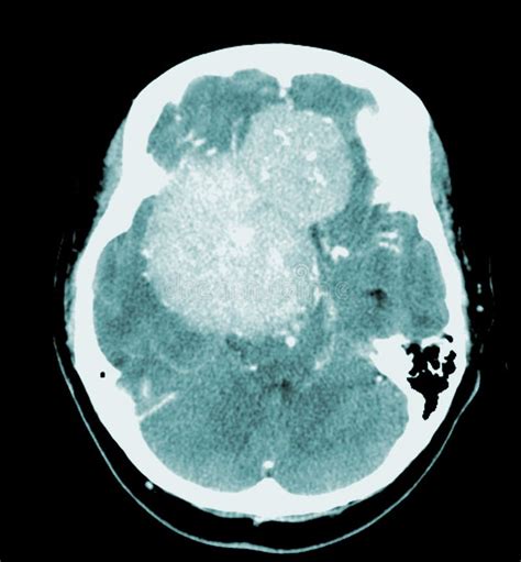 Ct Brain Axial Scans Hyperdense Mass With Homogeneous And Mild Perilesional Brain Edema At The