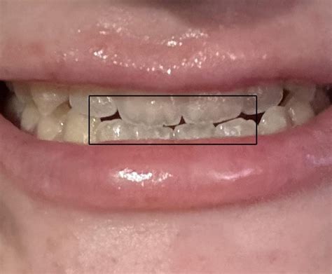 Clear Teeth And How To Fix Rdentalhygiene