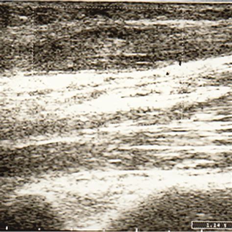 Pulmonary Ct Angiography Axial Showing Multiple Filling Defects Due To Download Scientific