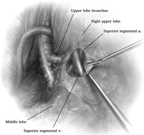 Minimally Invasive Segmentectomy Operative Techniques In Thoracic And Cardiovascular Surgery