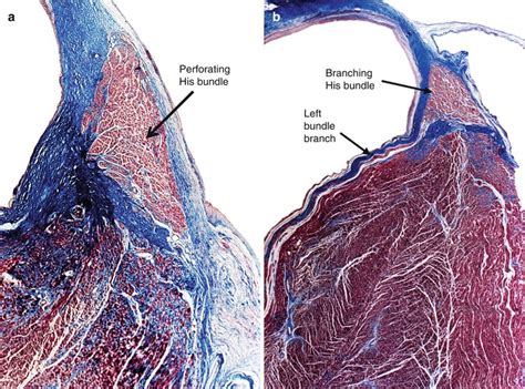 Pathology Of The Cardiac Conduction System Thoracic Key