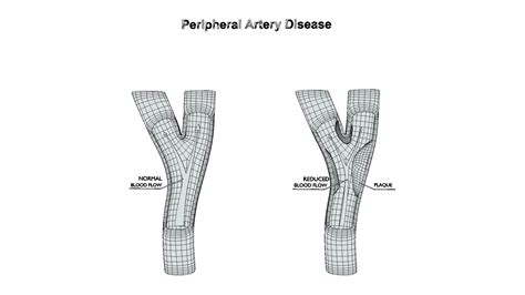 Peripheral Artery Disease Pad Medical Science 3d Model