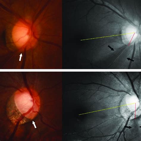 The Confusion Matrix Of Classification Into Glaucoma Stages Using Lda