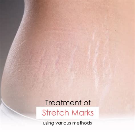 Stretch Marks Removal Executive Clinics And Day Care