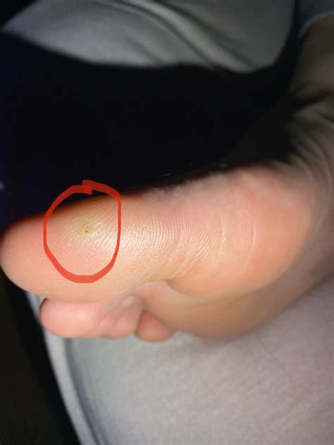 Шпора на пальце ноги Вопрос хирургу 03 Онлайн