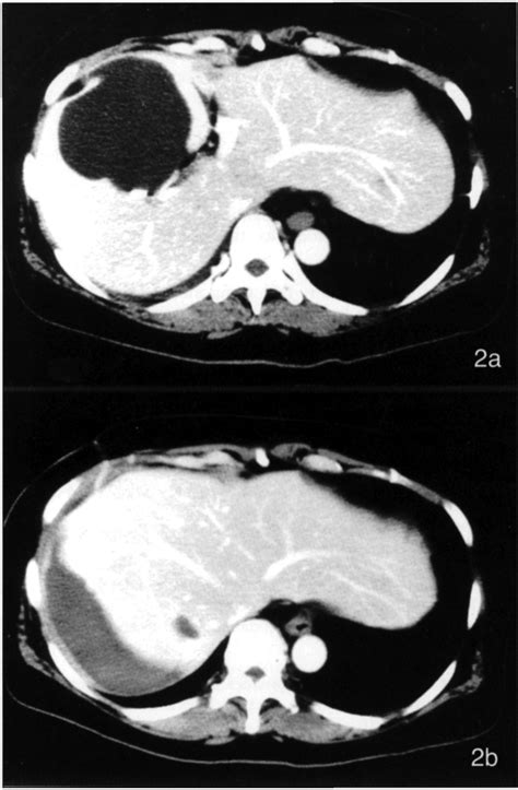Computed Tomography After Laparoscopic Cholecystectomy Demonstrating An Download Scientific