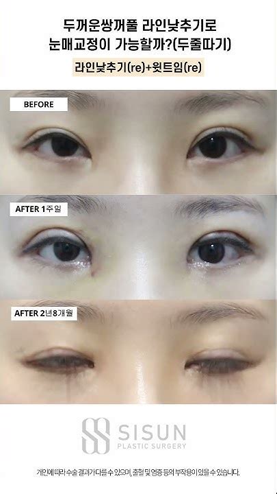 두꺼운쌍꺼풀 라인낮추기로 눈매교정이 가능할까 두줄따기 시선성형외과 Shorts Youtube