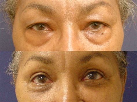 Dr Sandra Lee Patient Upper Blephroplasty Aferican American Skinps