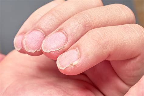 Alopecia Areata Nails Images Symptoms And Treatment