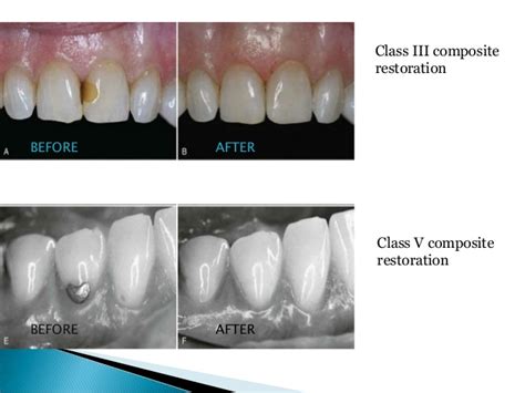 Composite Class 3 And Class 5 Composite Class 3 And Class 5