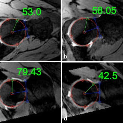 Exemplary Cases Of Setting A Best Fit Circle And Subsequent Alpha Angle