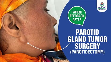 Parotid Gland Tumor Removal