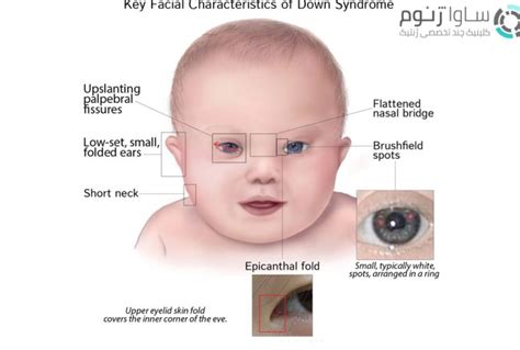 عکس نوزاد تازه متولد شده سندروم داون