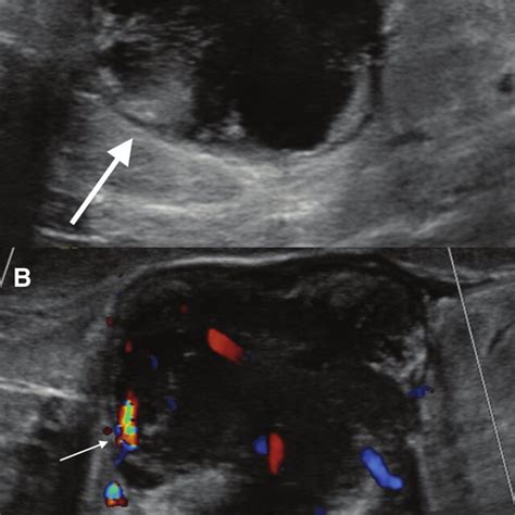 mammogram of the right breast a with tomosynthesis spot compression