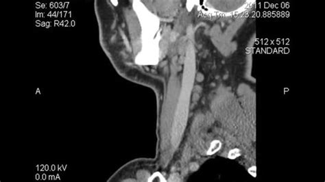 Sagittal Plane Tomography Ct Scan Layers Of Lower Face And Neck