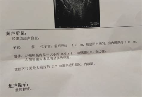 盆腔积液单子图片 盆腔积液图片与症状 大山谷图库
