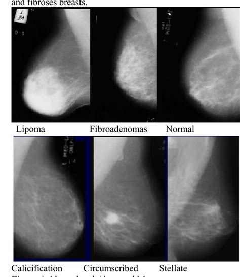 Figure 1 From A Dynamic Fuzzy Classifier For Detecting Abnormalities In Mammograms Semantic