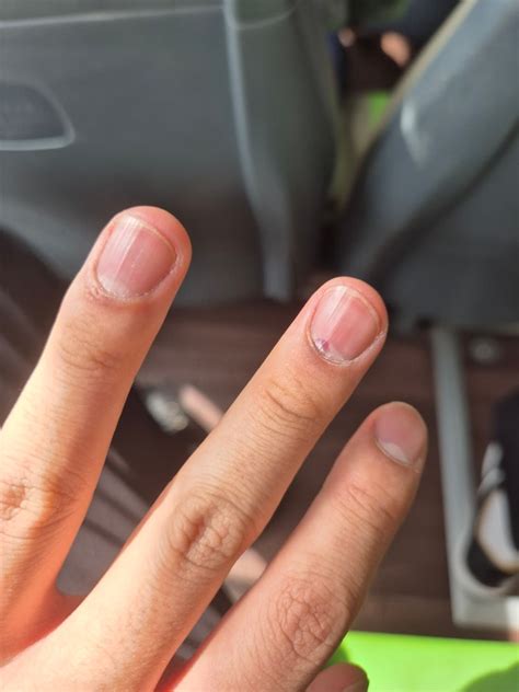 손톱 아래 붉은색 지식in