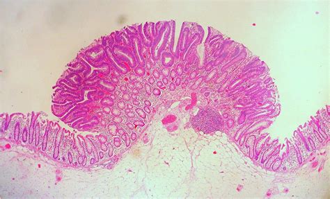 Brio Medical On Linkedin What Do Bleeding Colon Polyps Mean