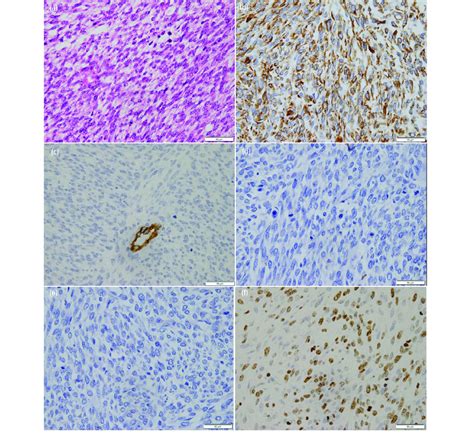 Histopathology Of The Prostatic Stromal Sarcoma Spindle Shaped Cells Download Scientific