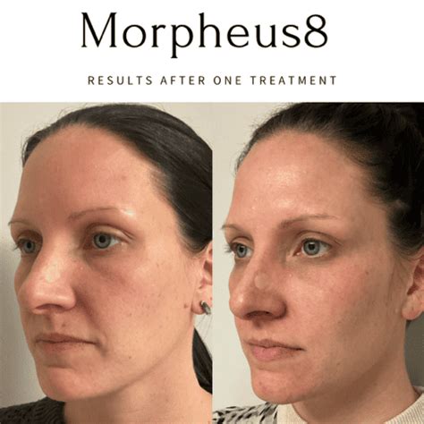 Morpheus 8 Before And After Images Emme Medical Spa