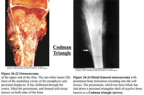 Osteogenic Sarcoma Codmans Triangle