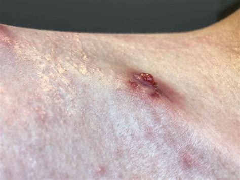 Hypergranulation überschießendes Granulationsgewebe Bei Wunden