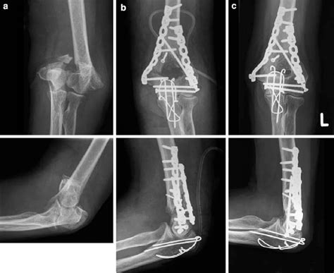 Distal Humerus Fracture Distal Humeral Fractures In The Adult