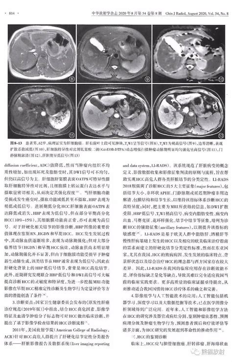 肝细胞癌丨影像学诊断及鉴别诊断 胆管