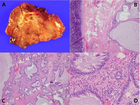 Pathologic Findings Of The Resected Specimen A Gross Findings B Download Scientific