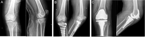 A B And C Schatzker Type Ii Tibial Plateau Fracture With Extensive Download Scientific