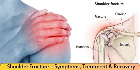 Shoulder Fracture Symptoms Treatment And Recovery Dr Vinil Shinde