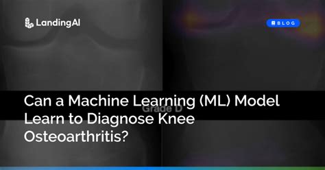 Can A Machine Learning Ml Model Learn To Diagnose Knee Osteoarthritis