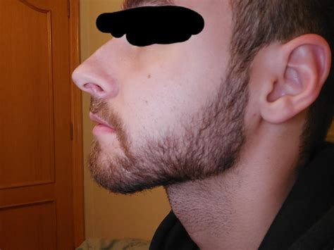 Overbite Can I Mew R Mewing