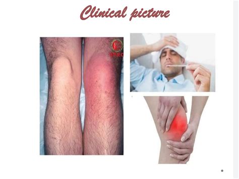 Septic Arthritis Clinical Orthopedics Pptx