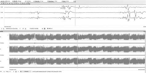 Aeeg Trace After Recovery Showing A Discontinuous Pattern With Download Scientific Diagram