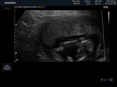 How Easy Is It To See Sex On Week Scan Mumsnet